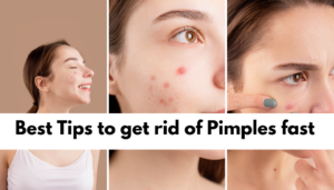 13 Best Tips to get rid of Pimples fast in 2026 - Bellflower Lifestyle