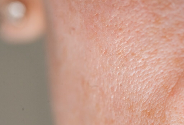 11 Most Common Causes of Oily Skin + How to fix - Bellflower Lifestyle